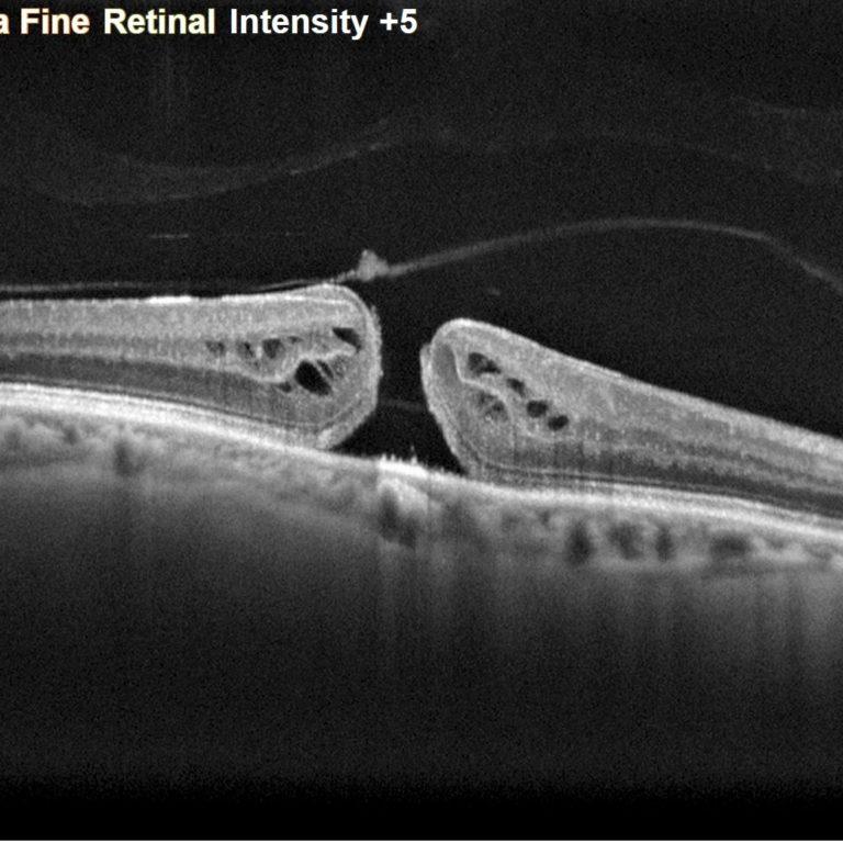 L'OCT-Angiographie : imagerie détaillée de la rétine - NIDEK France