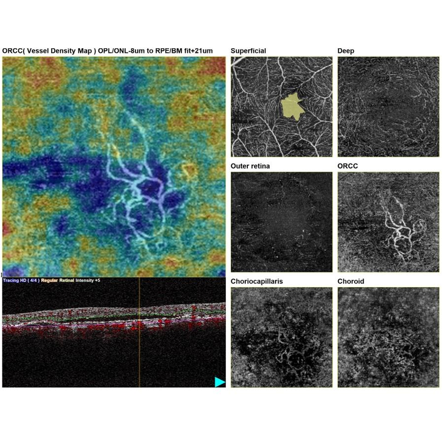 L'OCT-Angiographie : imagerie détaillée de la rétine - NIDEK France